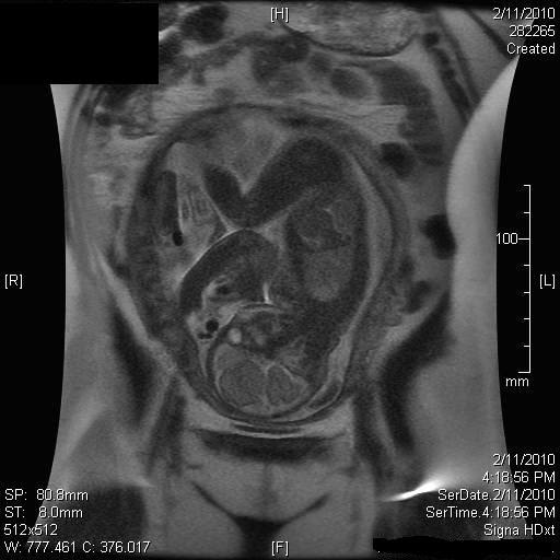 Despite the Best Laid Plans...: Mega Cisterna Magna