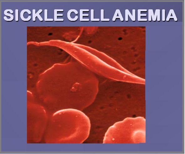BIOLOGI GONZAGA: SICKLEMIA