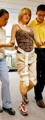 amputeeshares: Lindsay Ess [DBE][DBK]