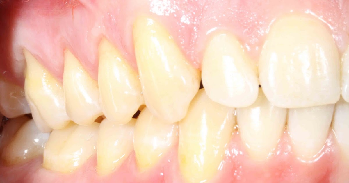 Parodontologie Bochum: Parodontologie/ Parodontosebehandlung in Bochum ...