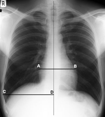 AKHSANUR BLOG'S: Cardiothoracic Ratio (CTR)