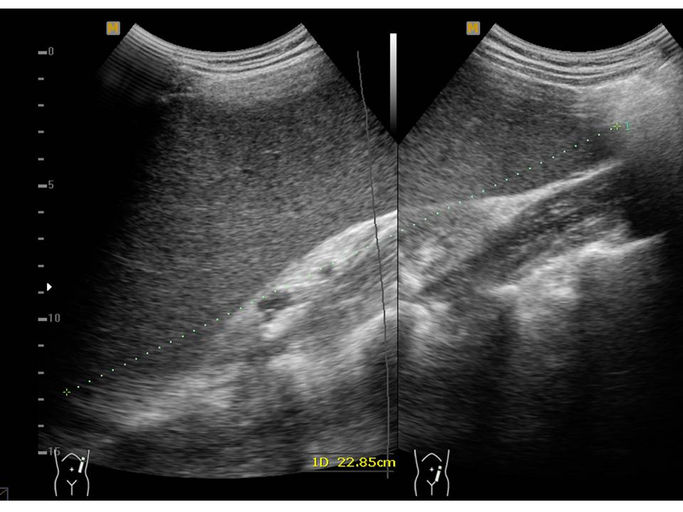 Splenomegaly; Enlarged Spleen