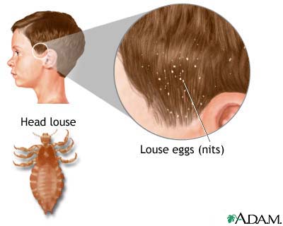 E Press Release Site: FDA Approves Natroba Paraprofessional Head Lice ...