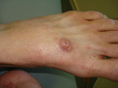 Skin Cancer College of ANZ Journal Updates: How Does Inflammation Cause ...