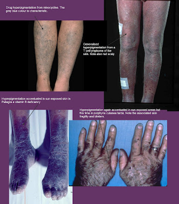 Differential Diagnosis in Dermatology: Hyperpigmentation generalised