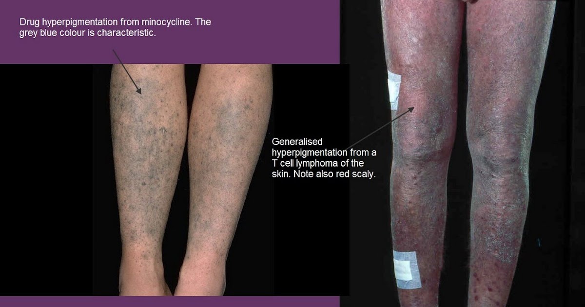 Dermatology Made simple: Hyperpigmentation generalised