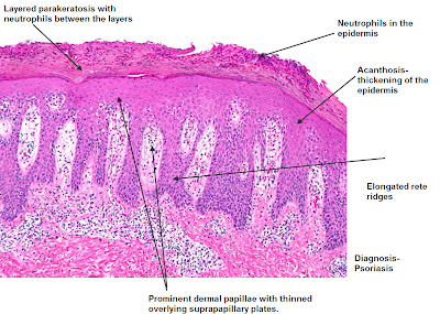 Teaching Dermatopathology: 9. Epidermal Patterns- Psoriasiform