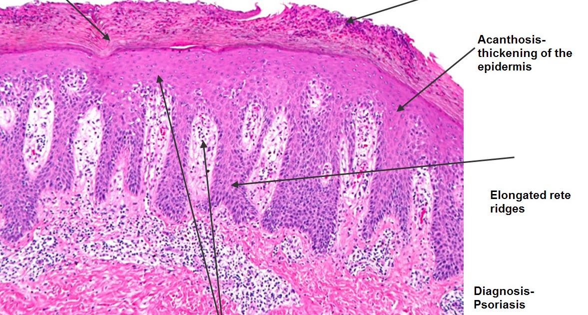 Teaching Dermatopathology: 9. Epidermal Patterns- Psoriasiform