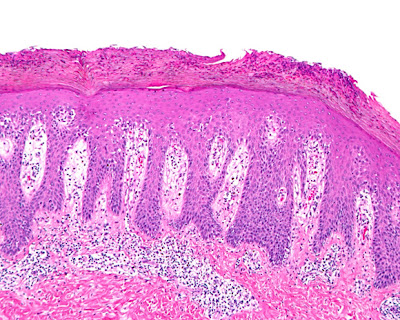 Teaching Dermatopathology: 9. Epidermal Patterns- Psoriasiform
