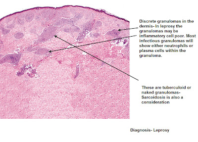 Teaching Dermatopathology: 14. Dermal Granulomatous pattern