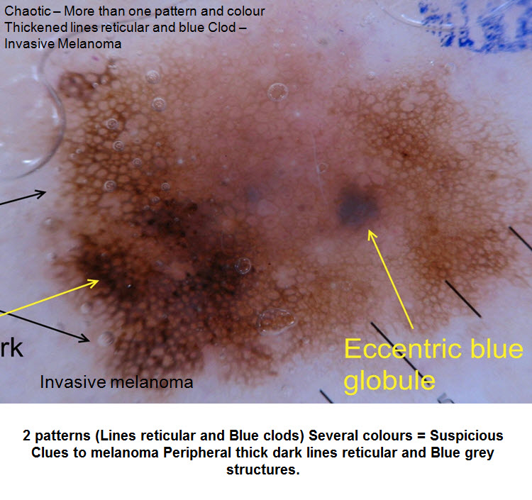 Dermoscopy Made Simple: Lines