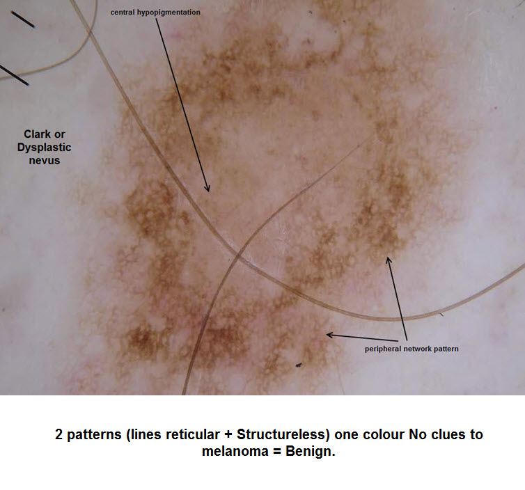Dermoscopy Made Simple: Lines