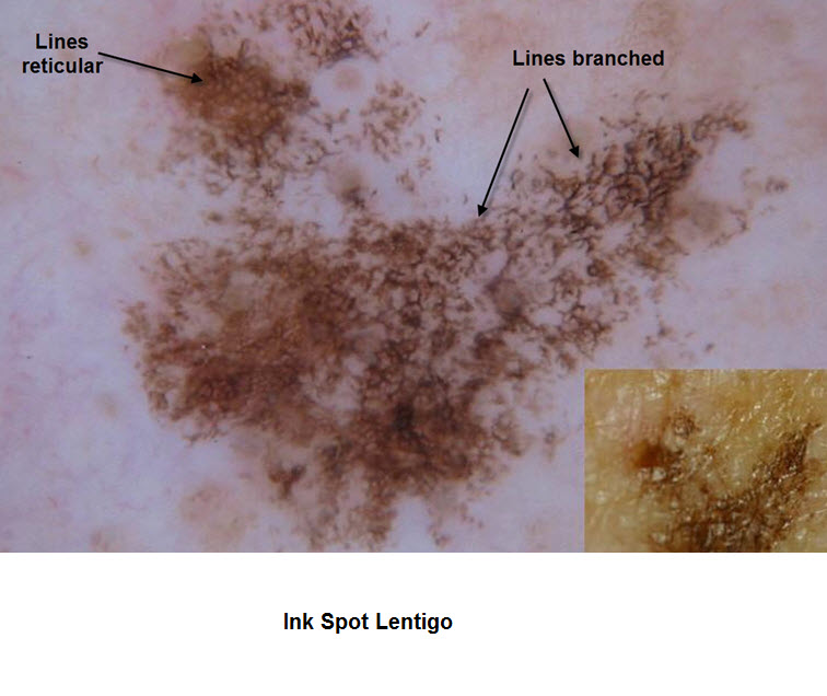 Dermoscopy Made Simple: Lines