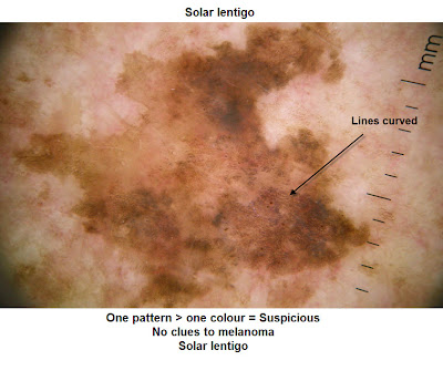 Dermoscopy Made Simple: Lines