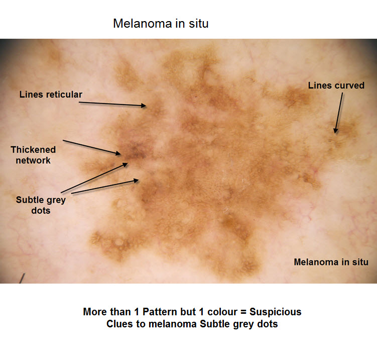 Dermoscopy Made Simple: Lines