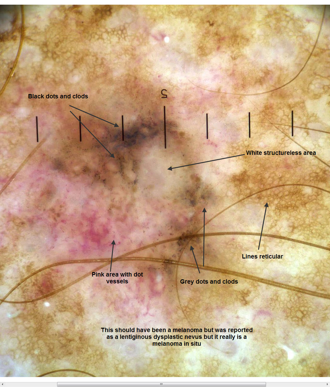 Dermoscopy Made Simple: Great Blog Cases