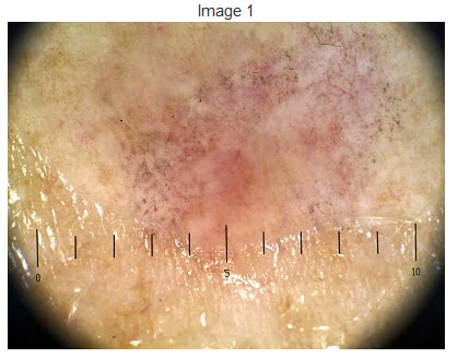 Dermoscopy Made Simple: Great Blog Cases