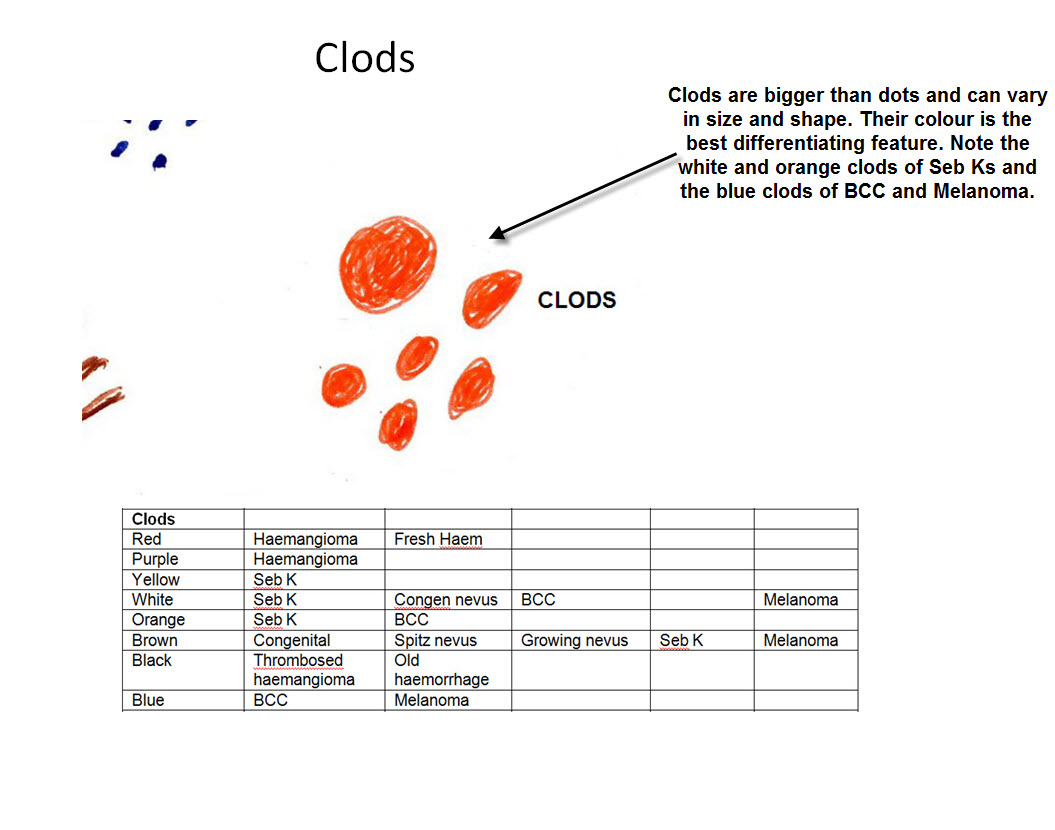 Dermoscopy Made Simple: Clods
