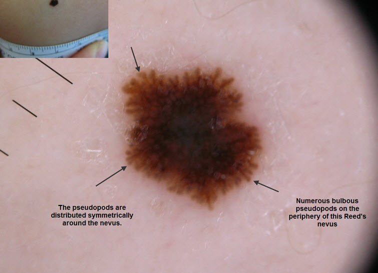 Dermoscopy Made Simple: Pseudopods