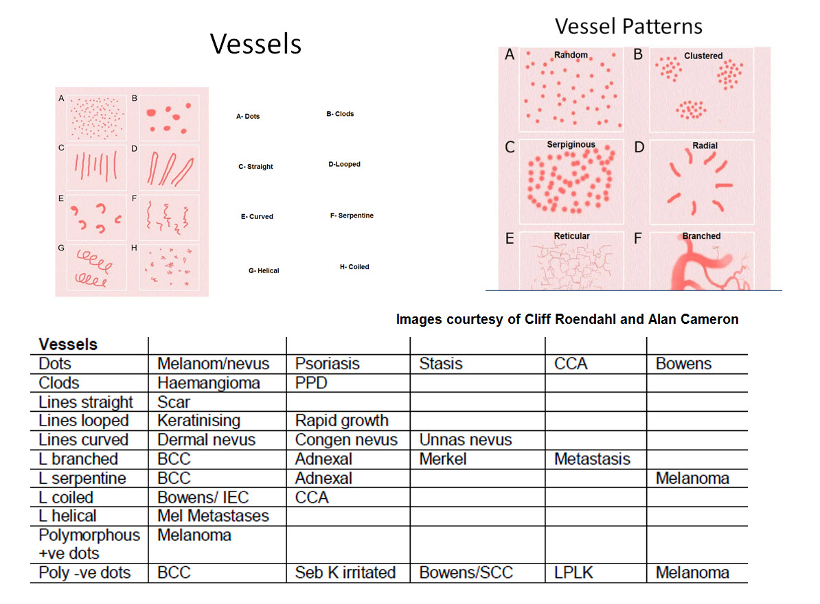 Dermoscopy Made Simple: Vessels