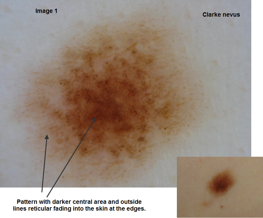 Dermoscopy Made Simple: Clark or Dysplastic nevi
