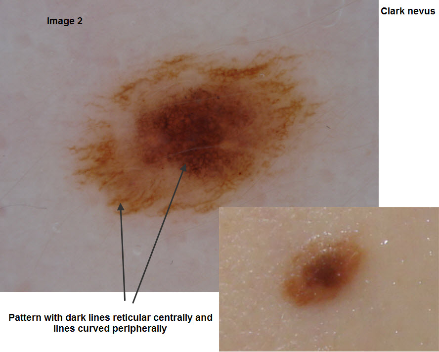 Dermoscopy Made Simple: Clark or Dysplastic nevi