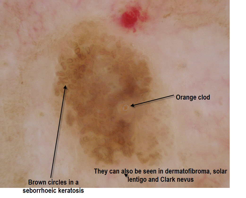 Dermoscopy Made Simple: Circles