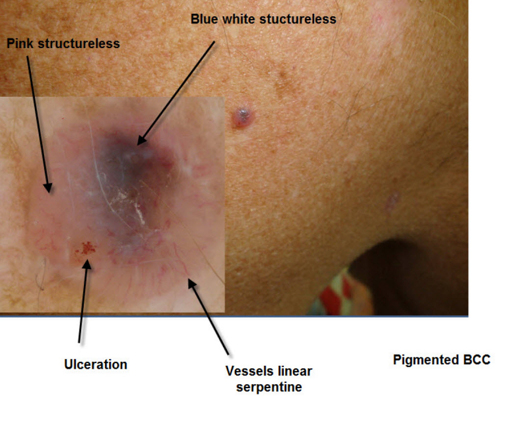 Dermoscopy Made Simple: Pigmented BCC