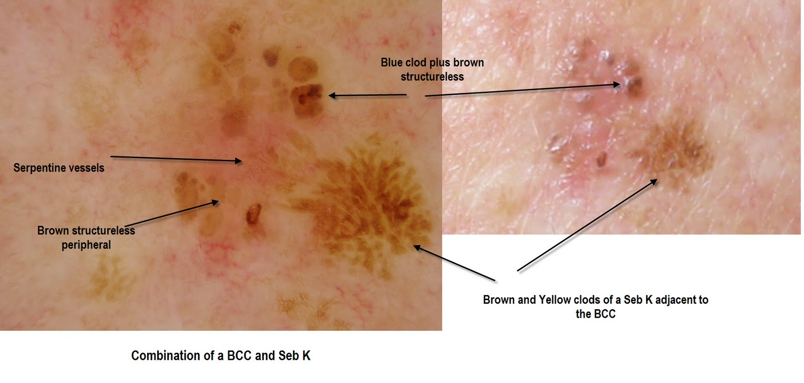 Dermoscopy Made Simple: Basal Cell Carcinoma
