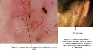 Dermoscopy Made Simple: Vessels