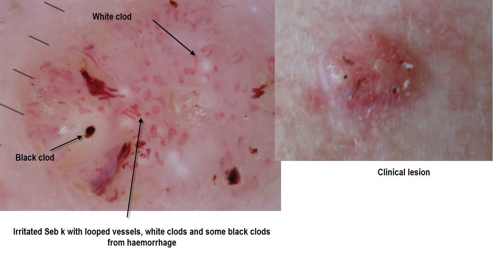 Dermoscopy Made Simple: Seborrhoeic Keratoses