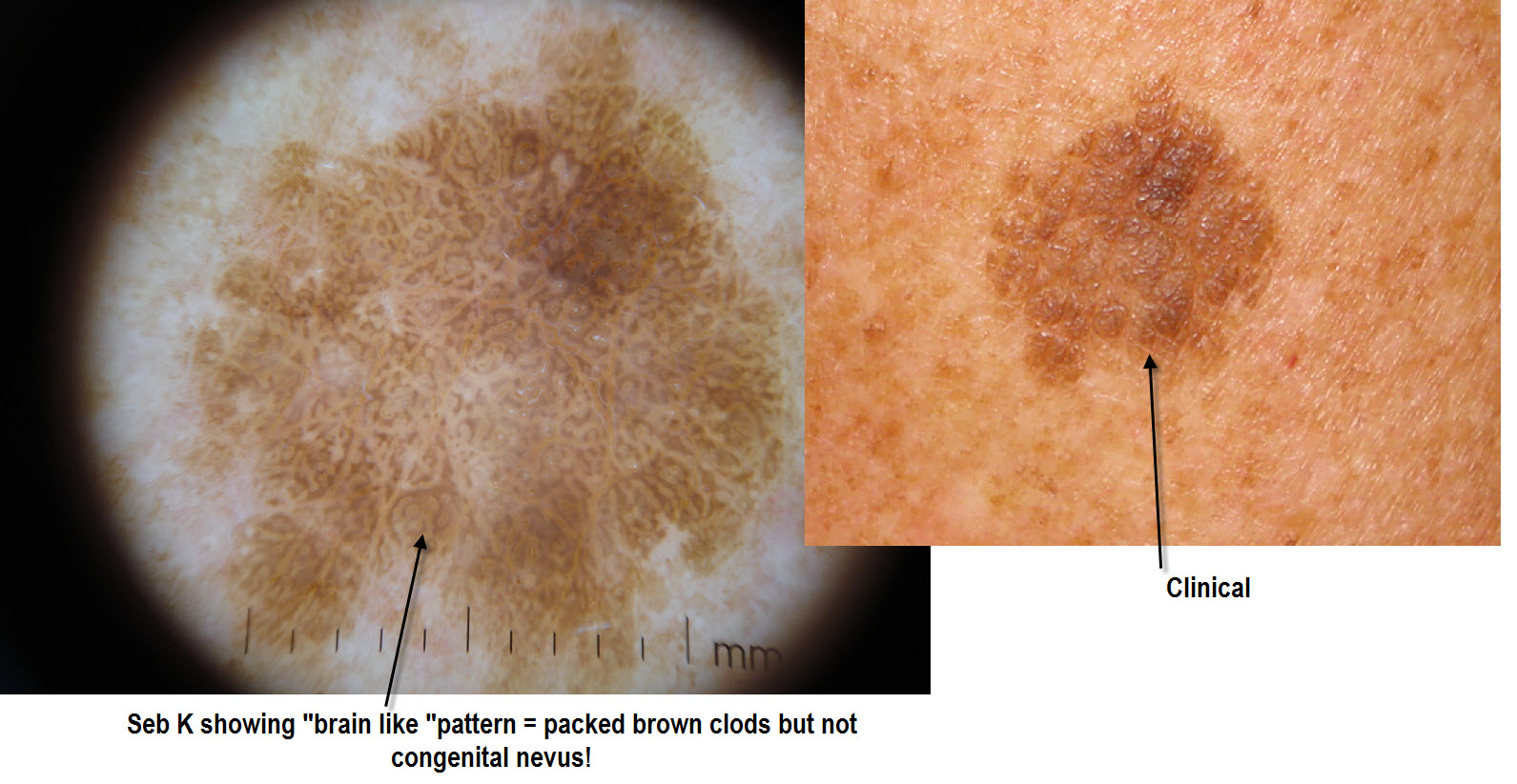Dermoscopy Made Simple Seborrhoeic Keratoses