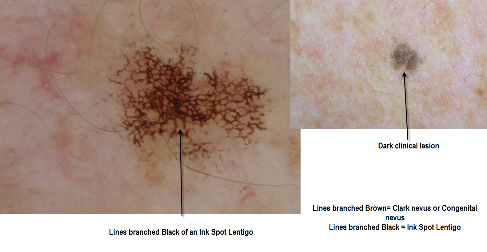 Dermoscopy Made Simple: Ink Spot Lentigo