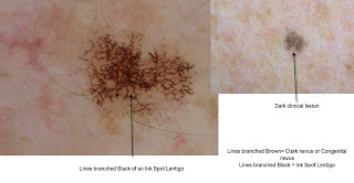 Dermoscopy Made Simple: Ink Spot Lentigo