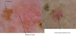 Dermoscopy Made Simple: Amelanotic Melanoma