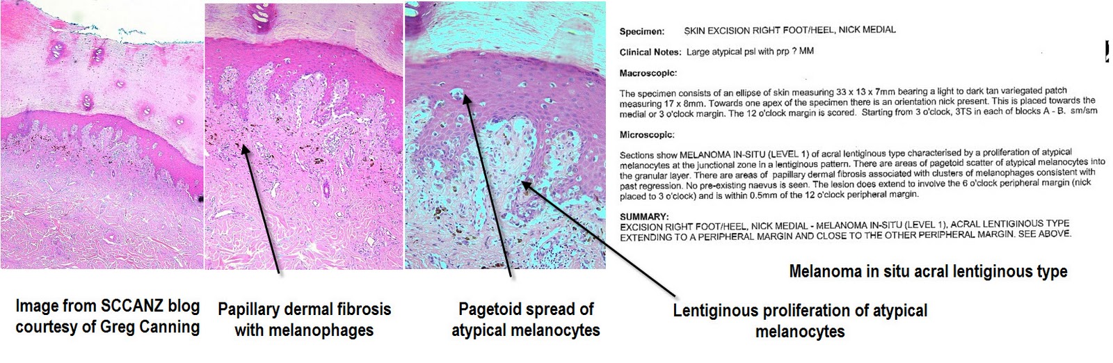 Dermoscopy Made Simple: Acral and Subungual Melanoma