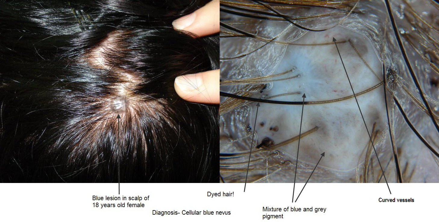 Dermoscopy Made Simple: Blue nevus