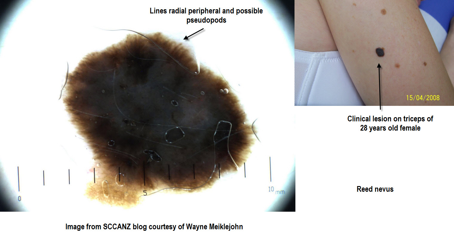 Dermoscopy Made Simple: Reed Nevus