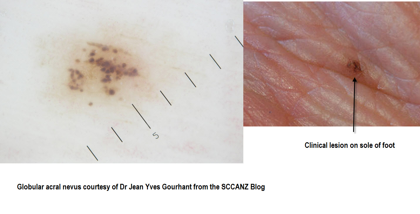 Dermatoscopy Made Simple: Acral nevus