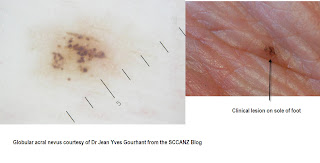 Dermoscopy Made Simple: Acral nevus