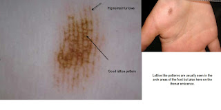 Dermoscopy Made Simple: Acral nevus