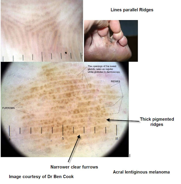 Dermoscopy Features as Clues: Clues to Melanoma