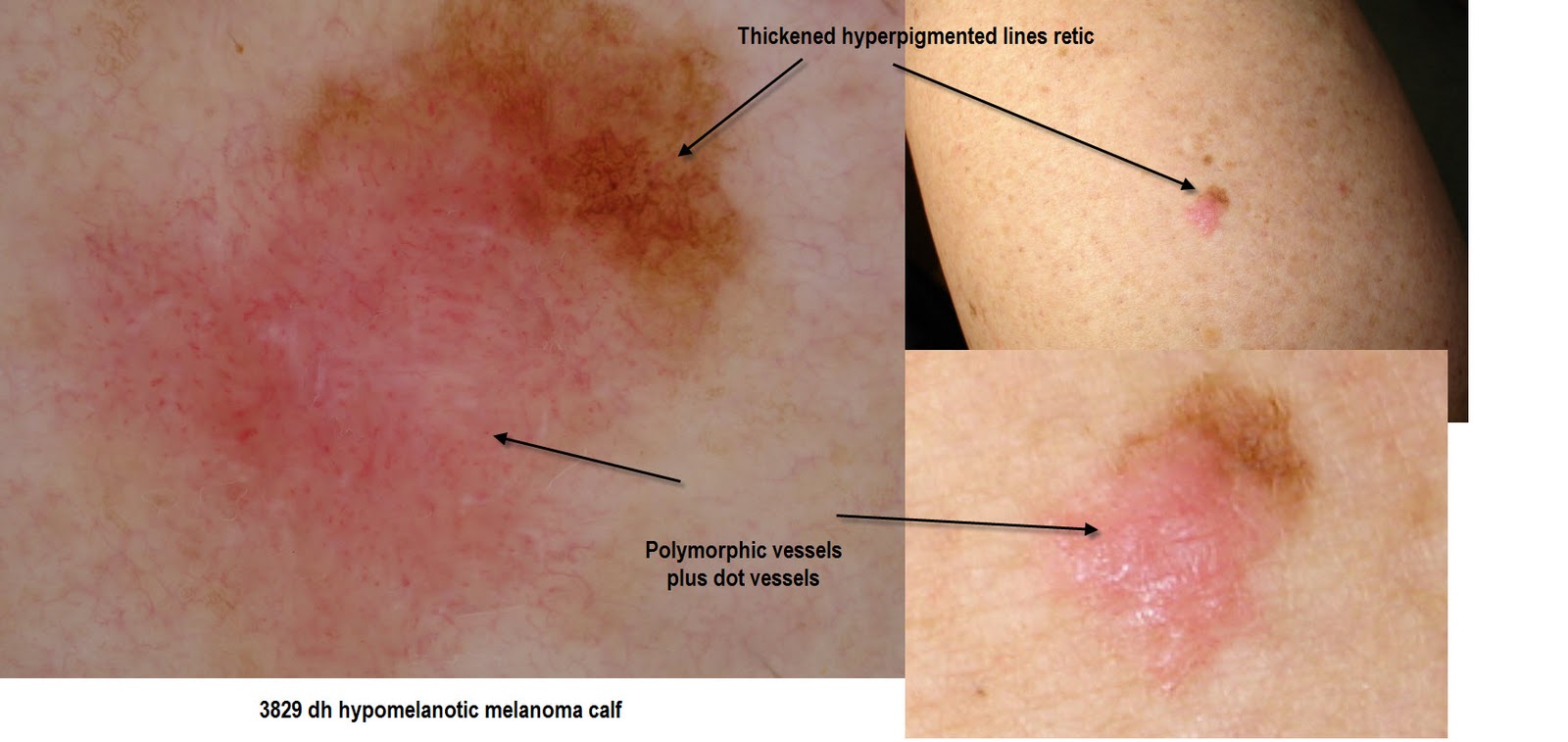 Dermoscopy Made Simple: Melanoma in situ mainly