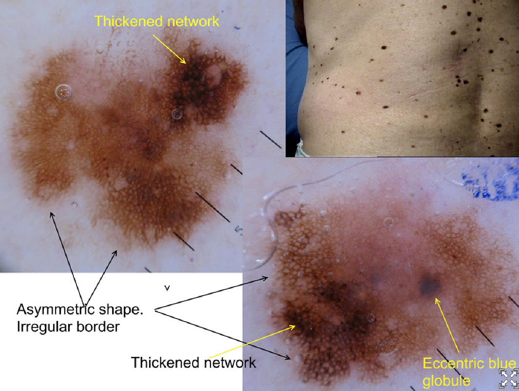 Dermoscopy Made Simple: Clark or Dysplastic nevi