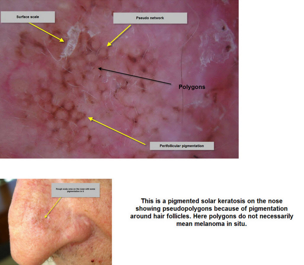 Dermoscopy Made Simple: Solar keratosis