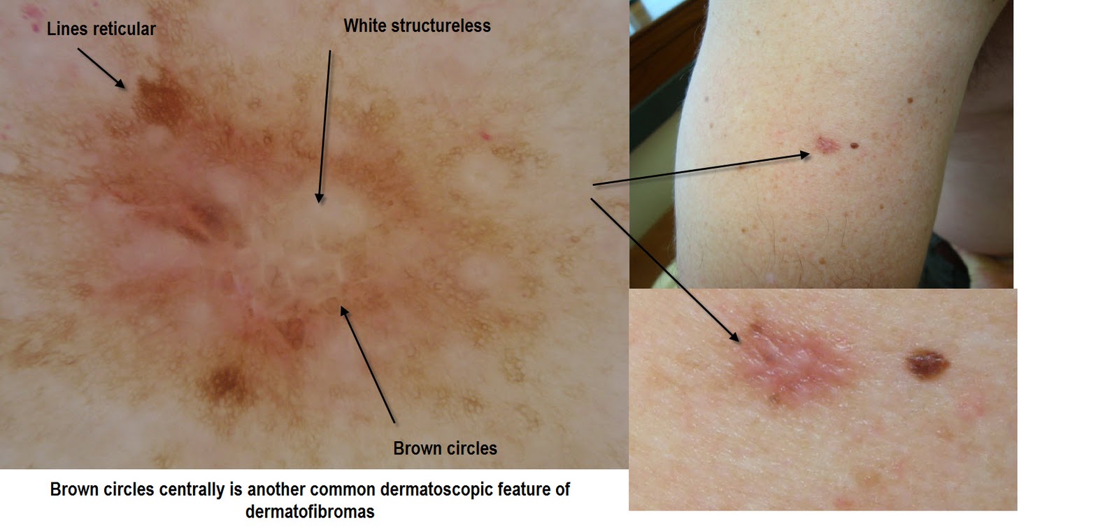 Dermoscopy Made Simple: Dermatofibroma