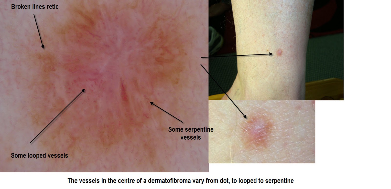 Dermoscopy Made Simple: Dermatofibroma