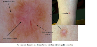 Dermoscopy Made Simple: Dermatofibroma