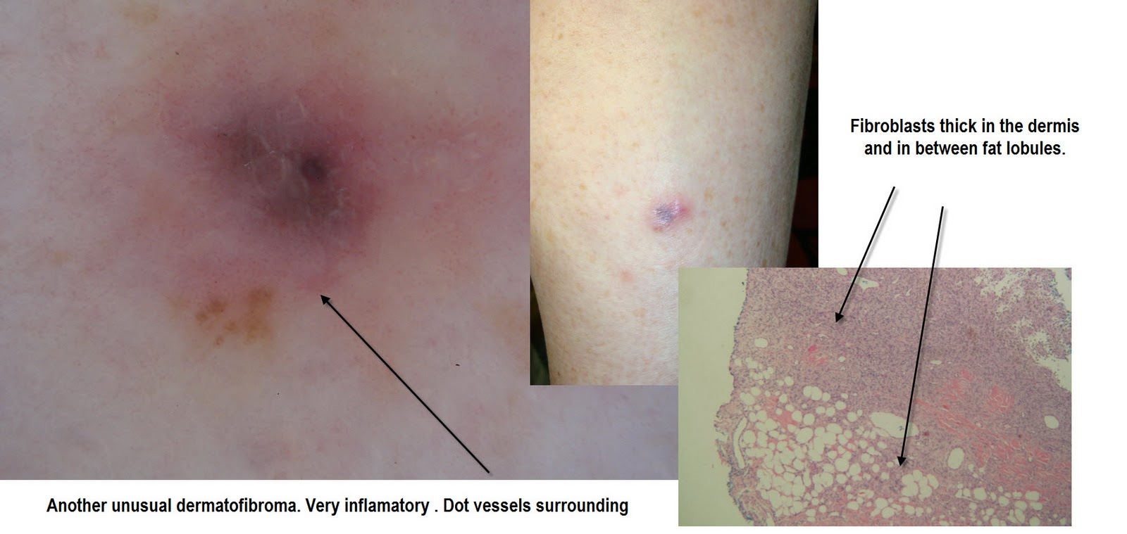 Dermatofibroma Dermoscopy