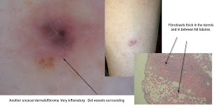 Dermoscopy Made Simple: Dermatofibroma